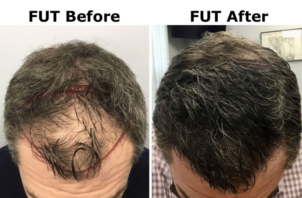 Hair Raising Decisions Fut Vs Fue Hair Transplants Examined